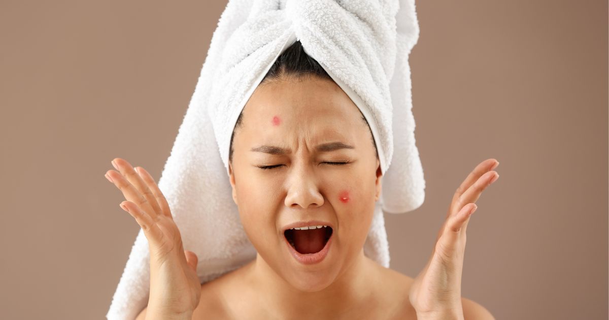 Nhận biết các loại mụn trên mặt