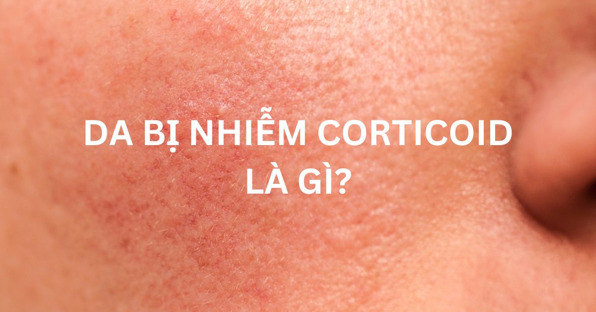 Da bị nhiễm corticoid là gì? và cách để điều trị